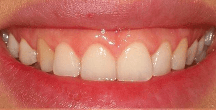 Smile Designing - GA Dental Clinics