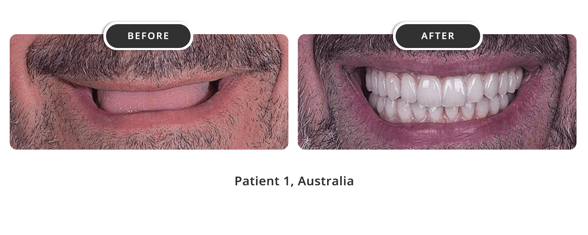 Smile Designing - GA Dental Clinics