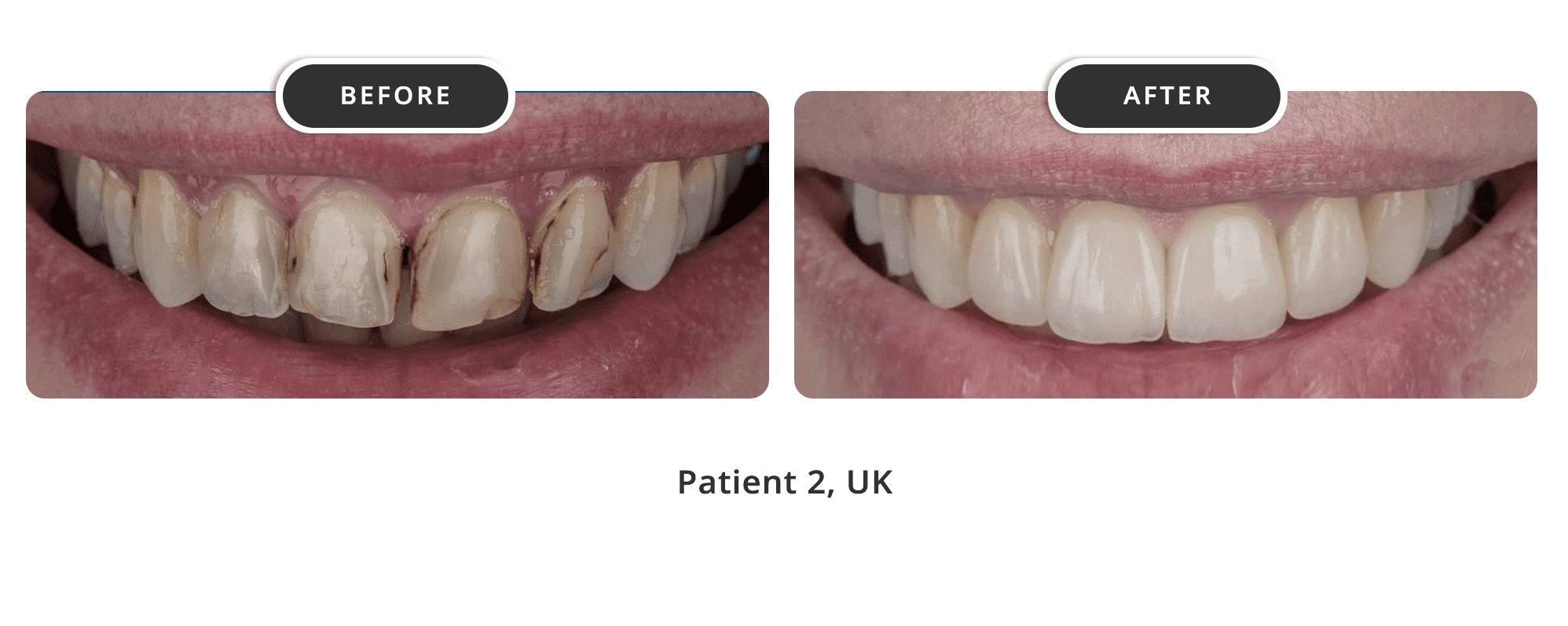 Smile Designing - GA Dental Clinics